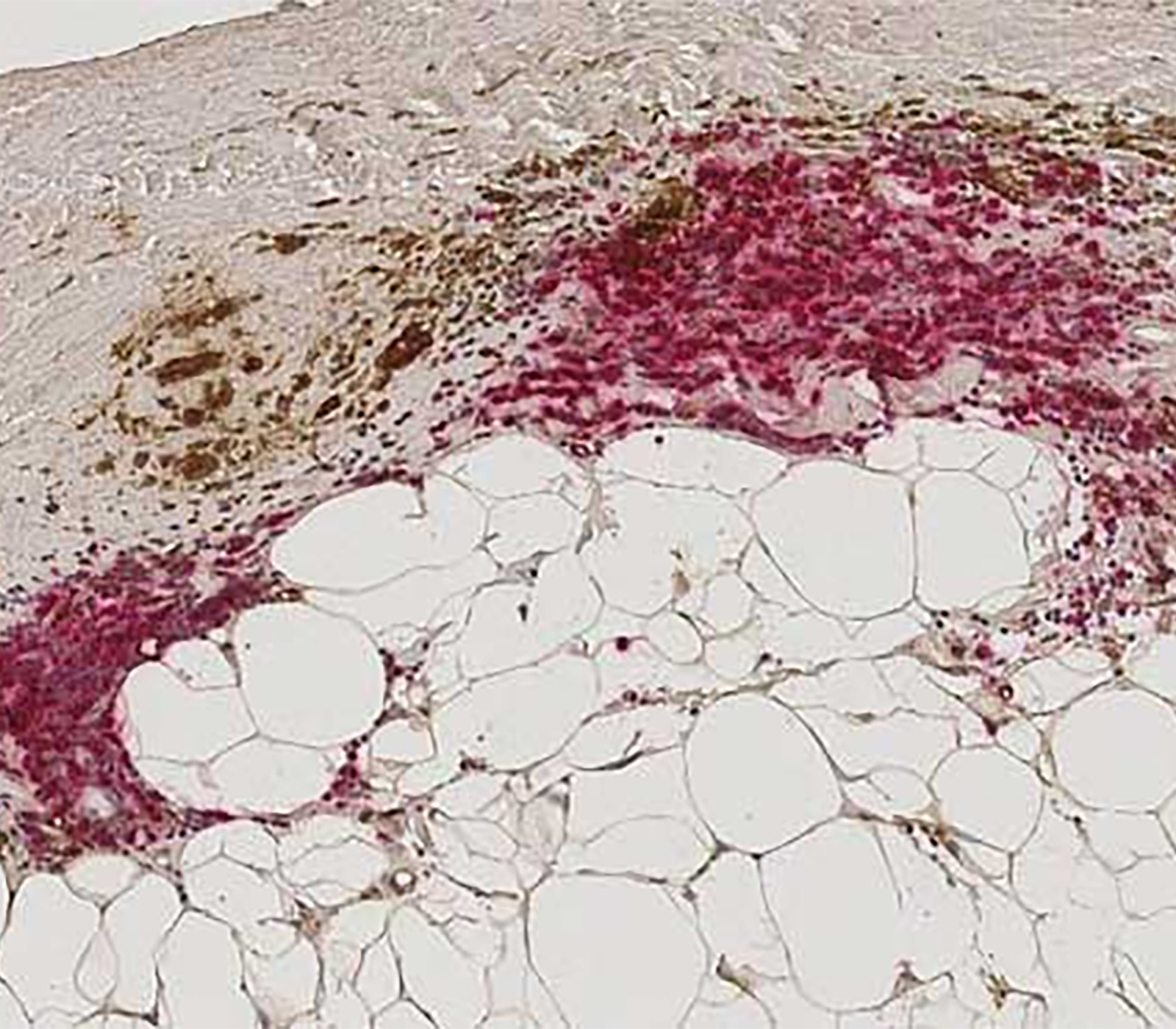 Characterization of Immune Cell Infiltrates in Human Cardiac Allograft ...